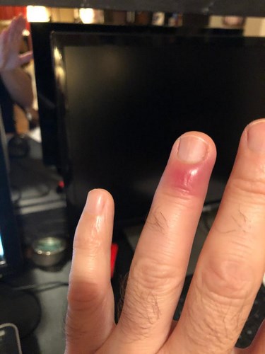 How to Drain a Pus-Filled Finger - Dr. Nick Campos